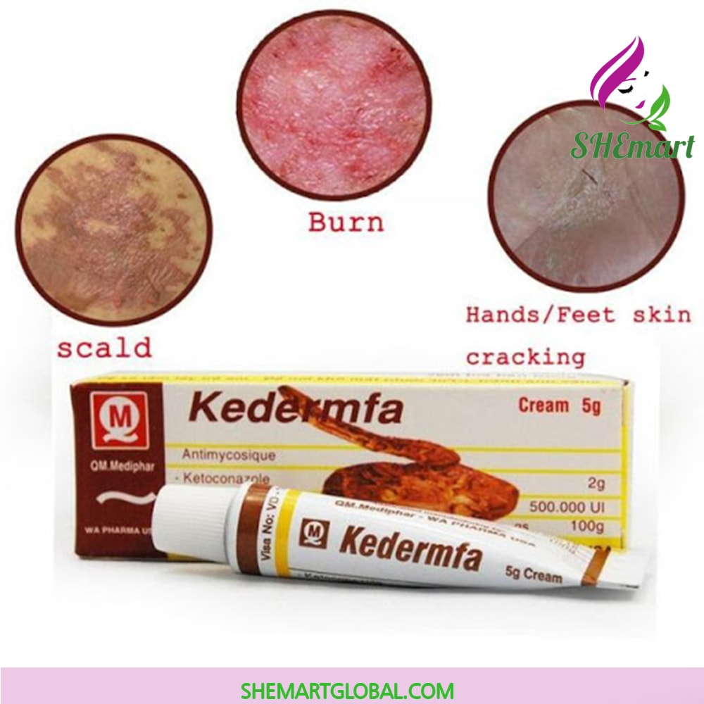 What is the best treatment for ringworm? - SHEmart Global